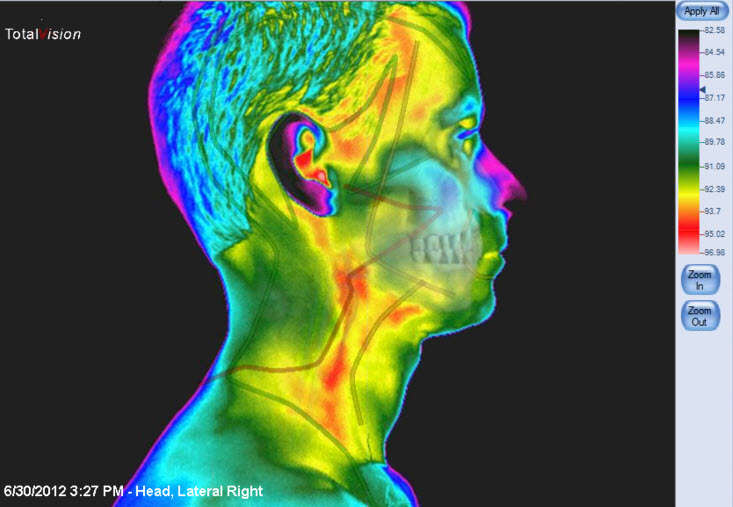 Meridians Lateral – Medische Thermografie